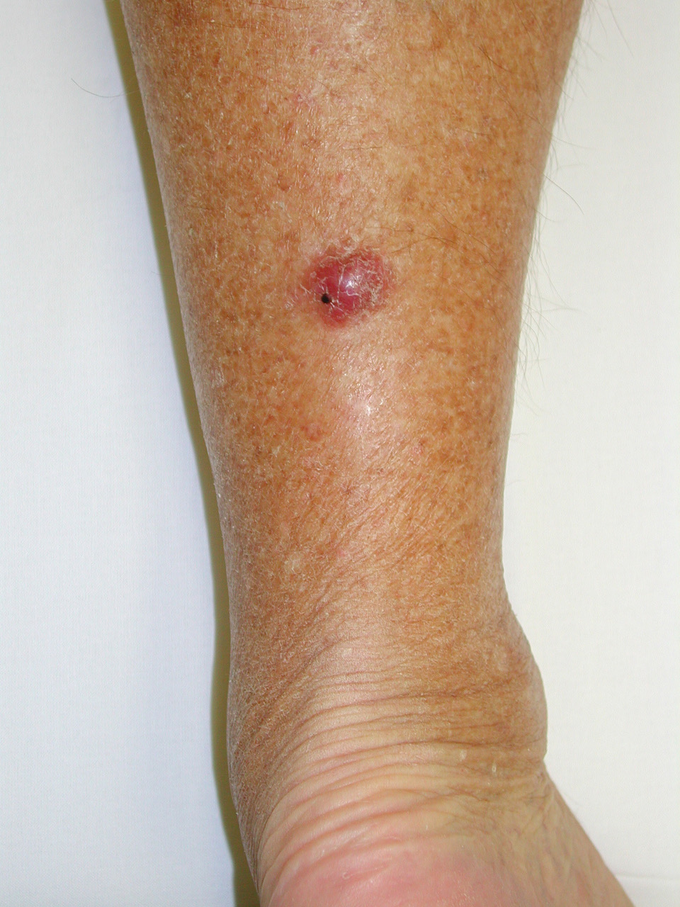Merkel Cell Carcinoma Peach Skin Clinic